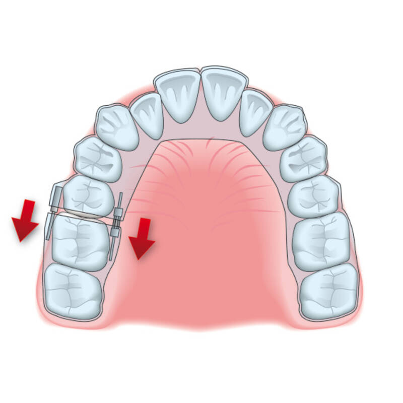 EXPANSION SCREW CA DISTALISER KIT